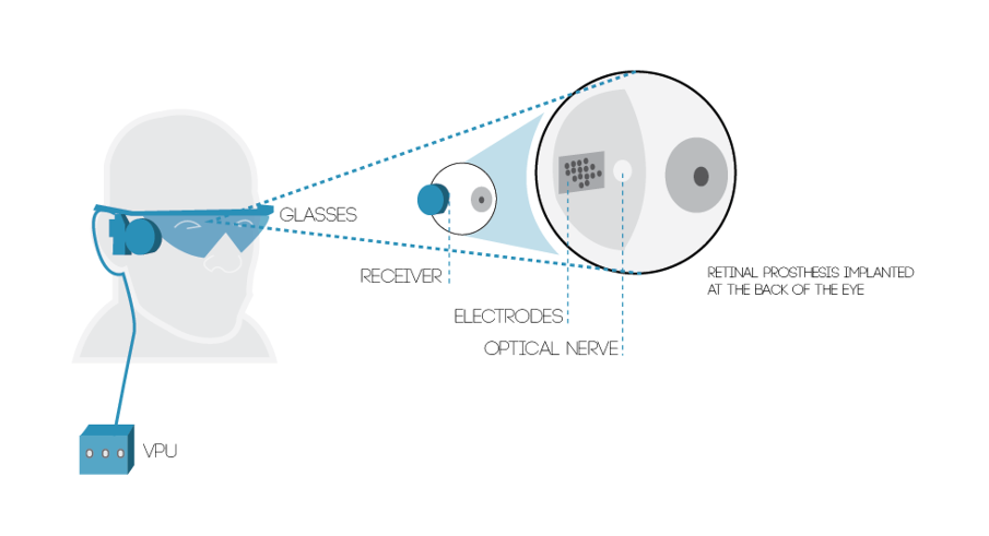 Argus II Retinal Prosthesis System - Future Health Systems
